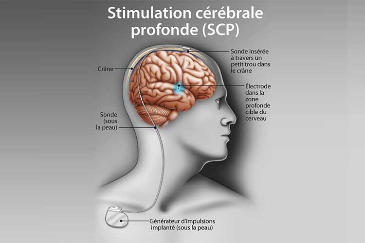 Neuromodulation Medware Neuromodulation Medware